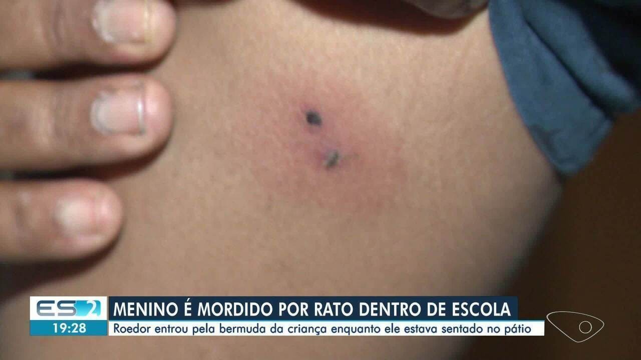 Menino mordido por rato em escola tem medo de voltar a estudar ...