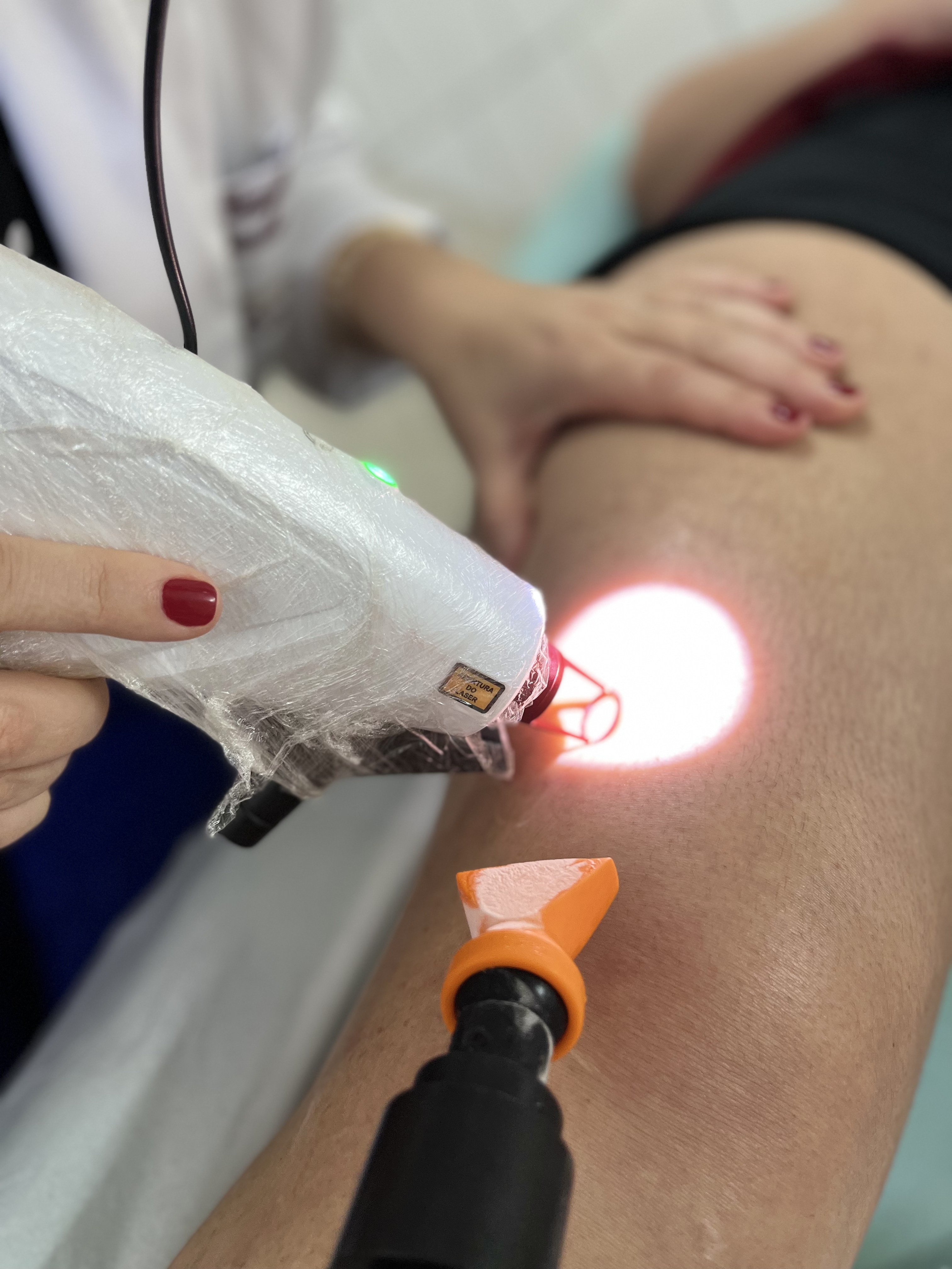 Inovação no tratamento de varizes: Laser Transdérmico e Escleroterapia | G1
