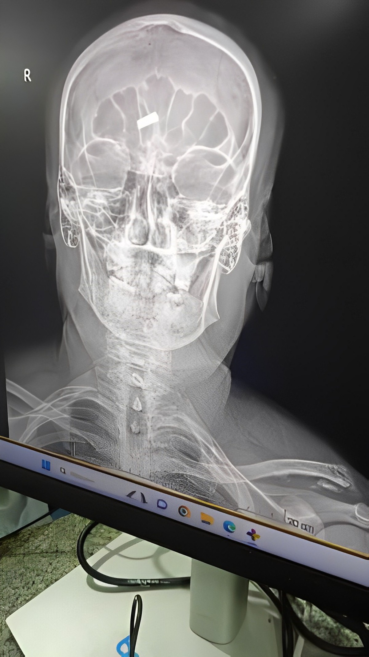 Homem é atingido com tiro na cabeça e sobrevive em Rorainópolis, Sul de ...