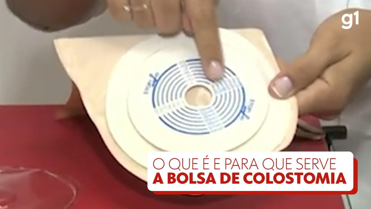 Colostomia definitiva: o que é o procedimento feito por Preta Gil ...