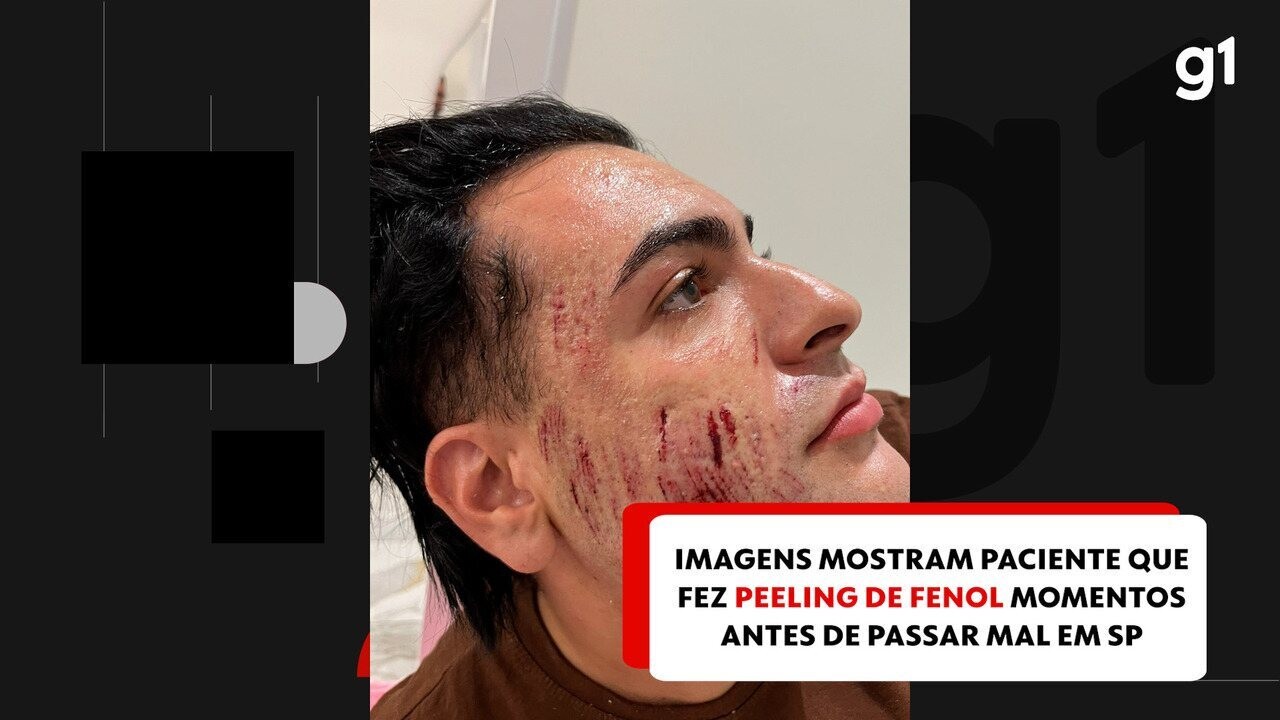 Peeling de fenol: veja tudo o que se sabe sobre empresário que morreu ...