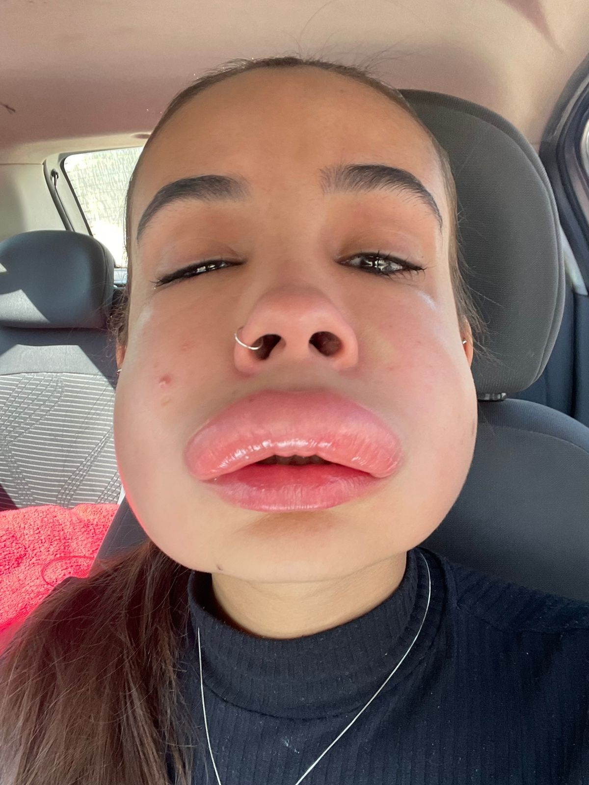 Estudante sofre reação alérgica ao corrigir preenchimento labial e faz ... Estudante sofre reação alérgica ao corrigir preenchimento labial e faz ...