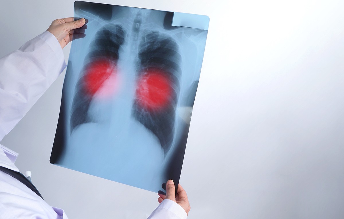 Entenda os tipos de tuberculose, doença alvo de busca ativa em ...