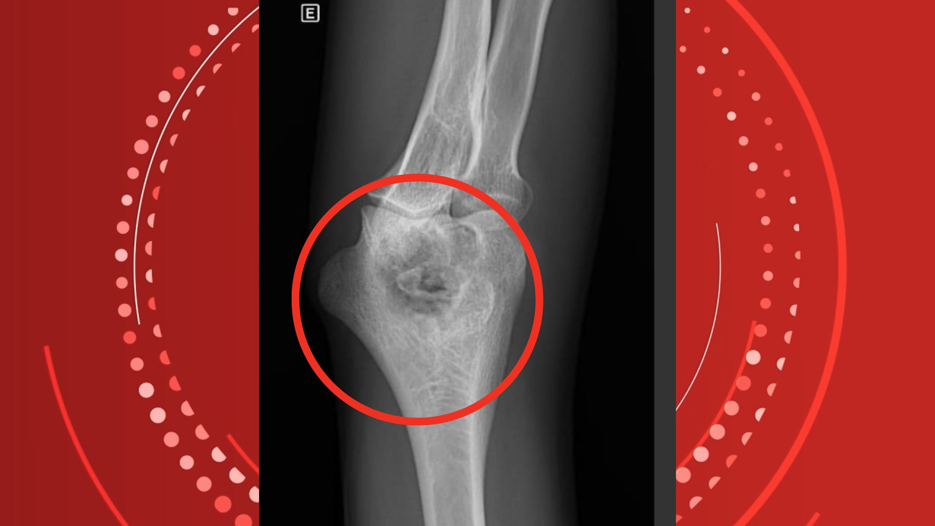 Adolescente descobre cisto raro no osso após meses sentindo dores no ...