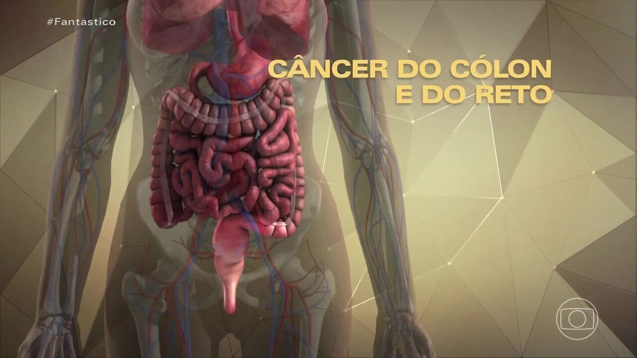 Saiba como é feito o diagnóstico do câncer de intestino