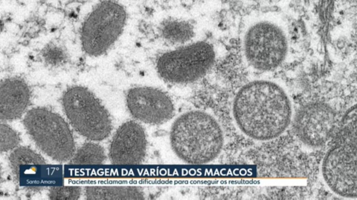 Varíola: O Que É, Sintomas, Transmissão E Tratamento – KOAUJQ