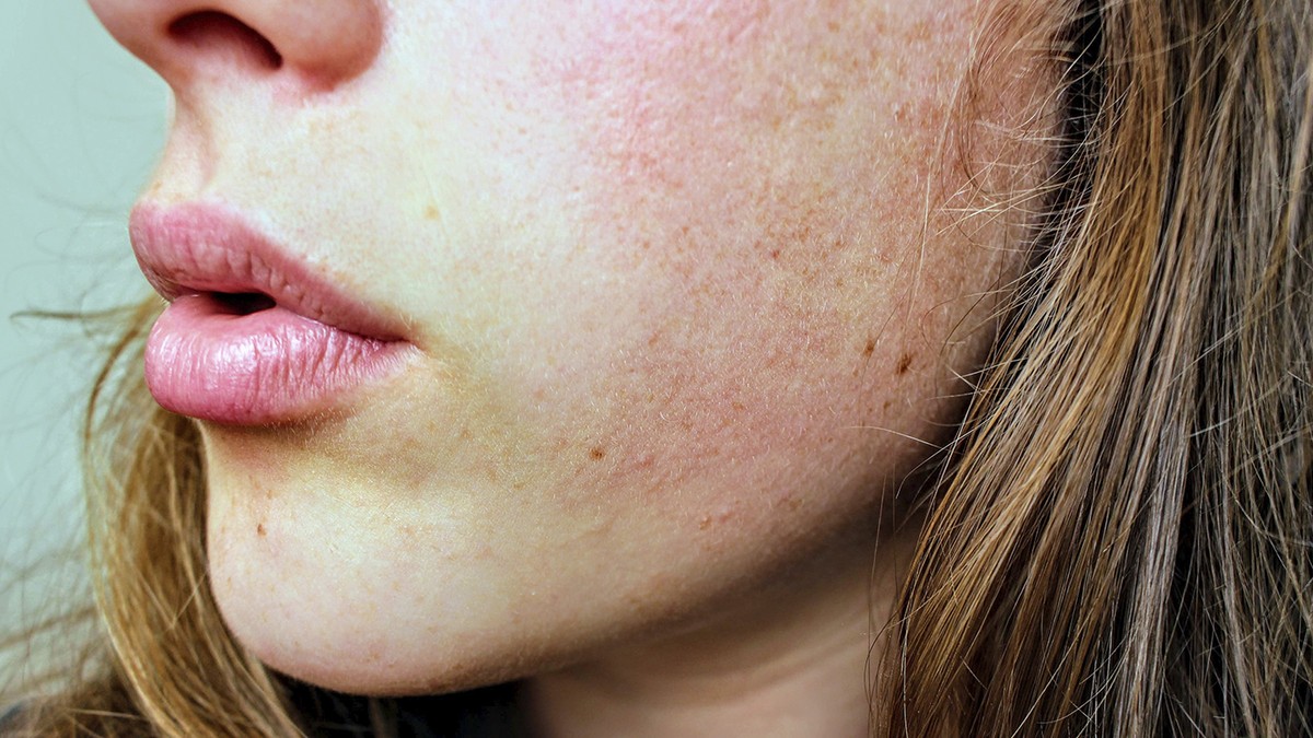 Acne pode ser o vilão da pele em adultos: saiba como é possível tratar ...