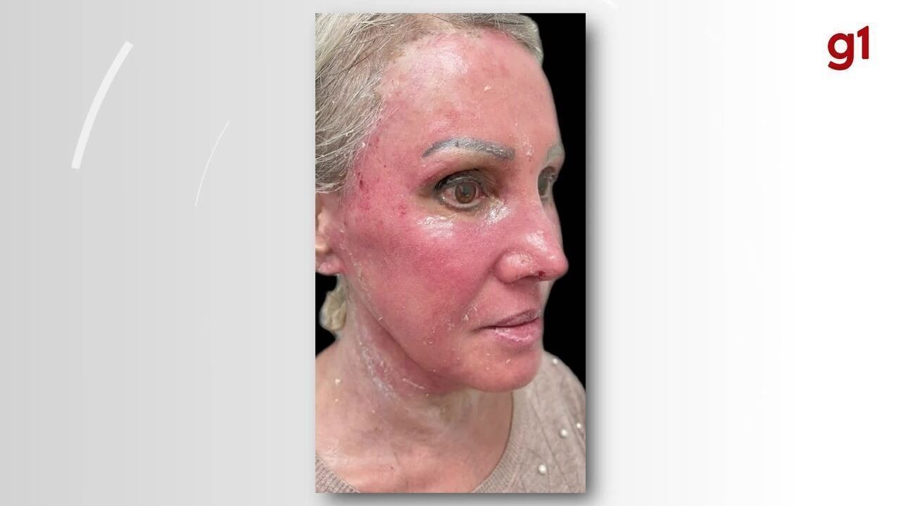 Peeling de fenol: agressiva, queimadura química que 'renova' a pele não ...