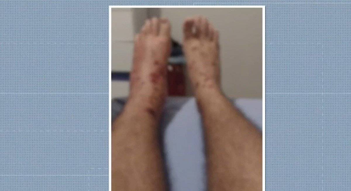 Varíola dos macacos: Saúde do Acre investiga sintomas da doença em ...