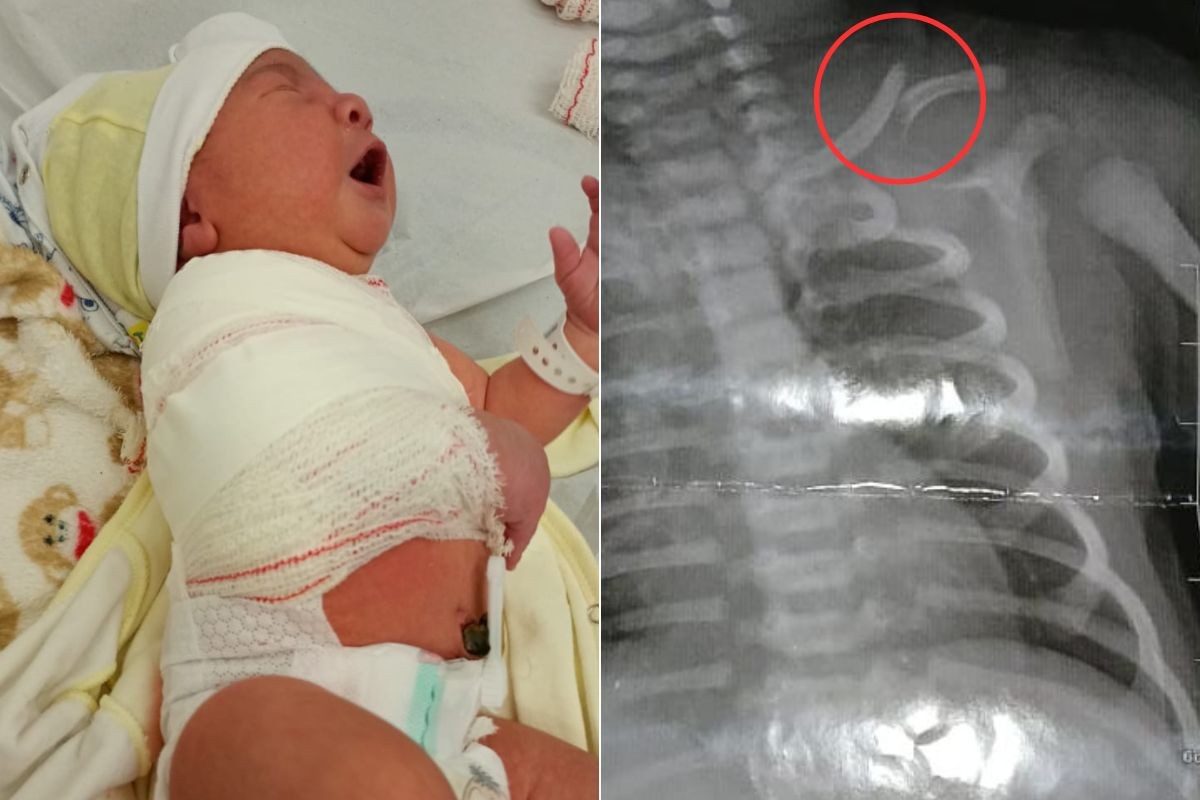 Fratura de clavícula no parto: lesão pode deixar sequelas no bebê ...