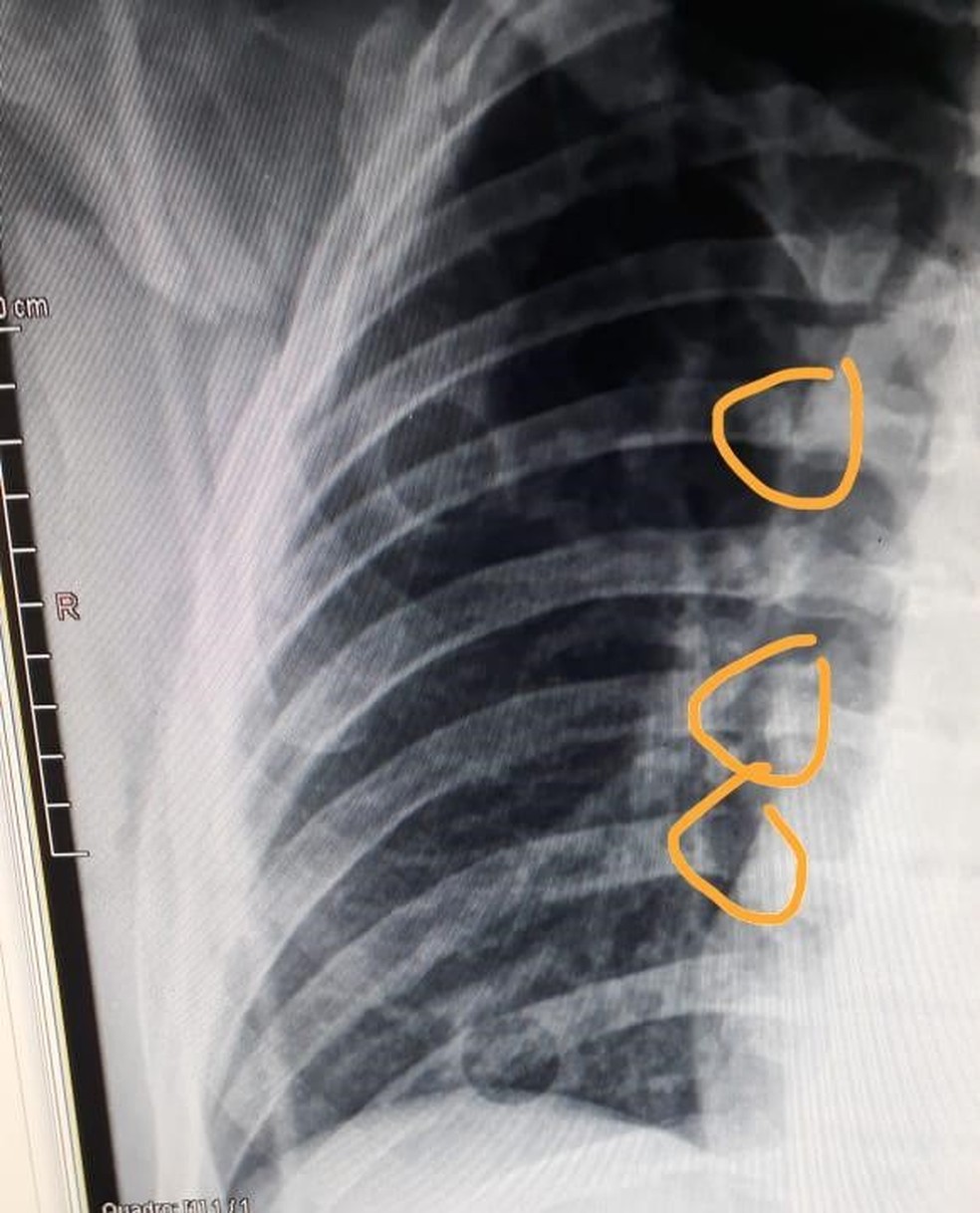 Raio X De Costelas Quebradas DICAS DE RADIOLOGIA Tudo Sobre