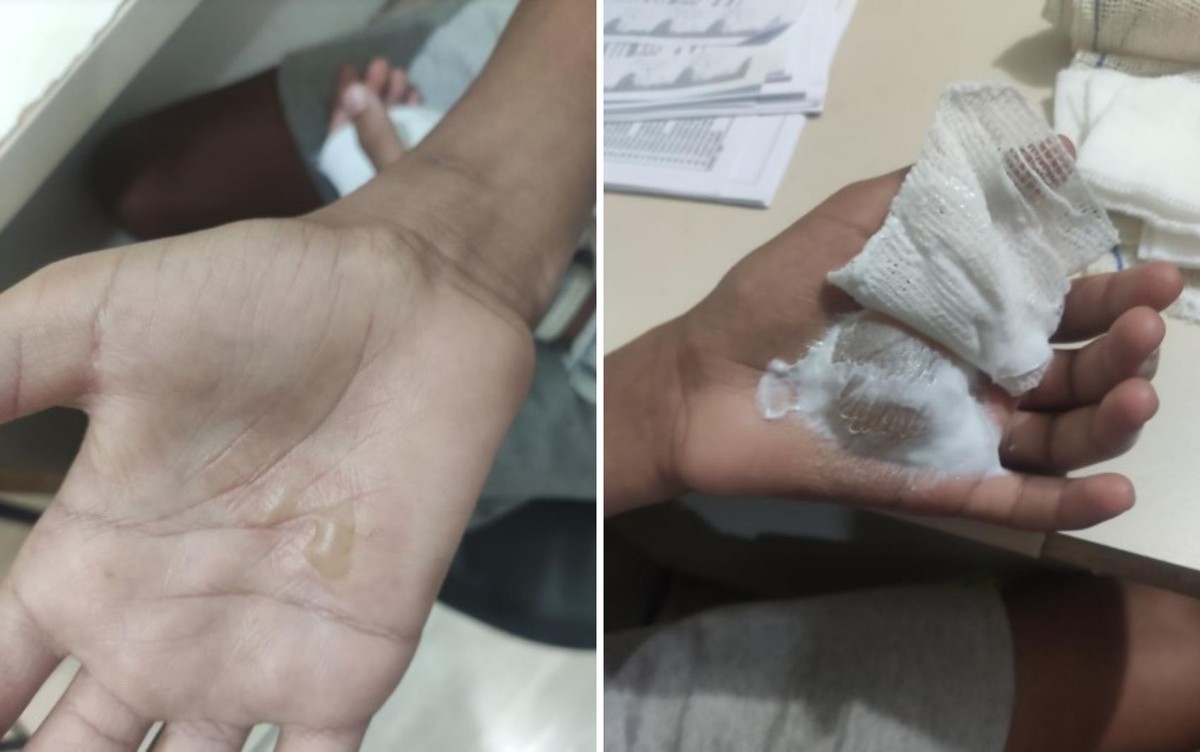 Mãe E Madrasta São Suspeitas De Espancar Menino Com Madeira E Queimá Lo