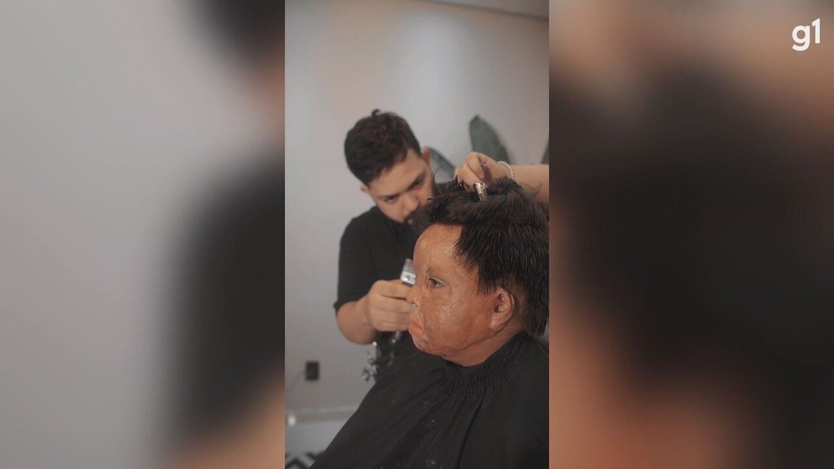 Menino com 100% do rosto queimado por óleo de cozinha realiza sonho ao ...
