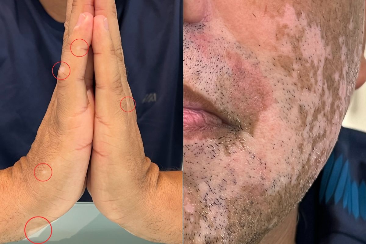 Homem com 98% do corpo com vitiligo termina o relacionamento, e manchas ...