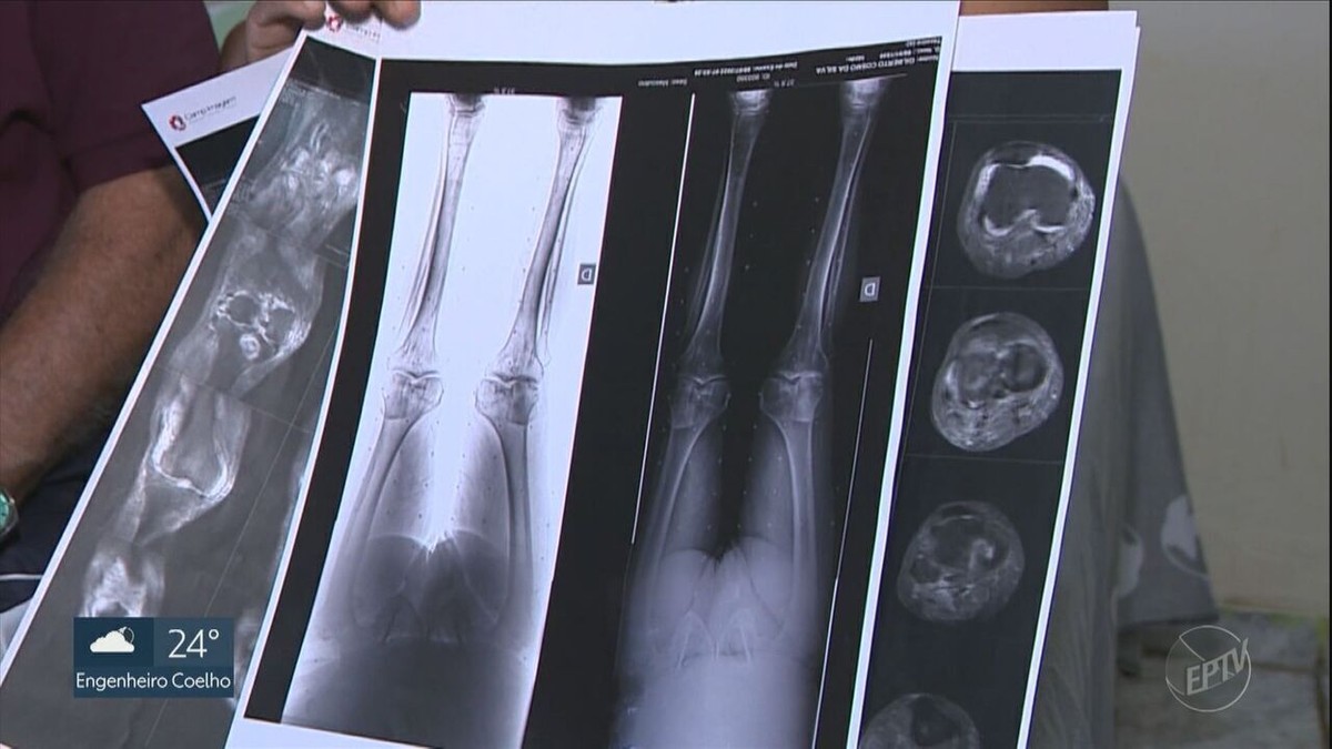 Fila por cirurgia no SUS em Campinas inclui paciente com câncer de mama ...