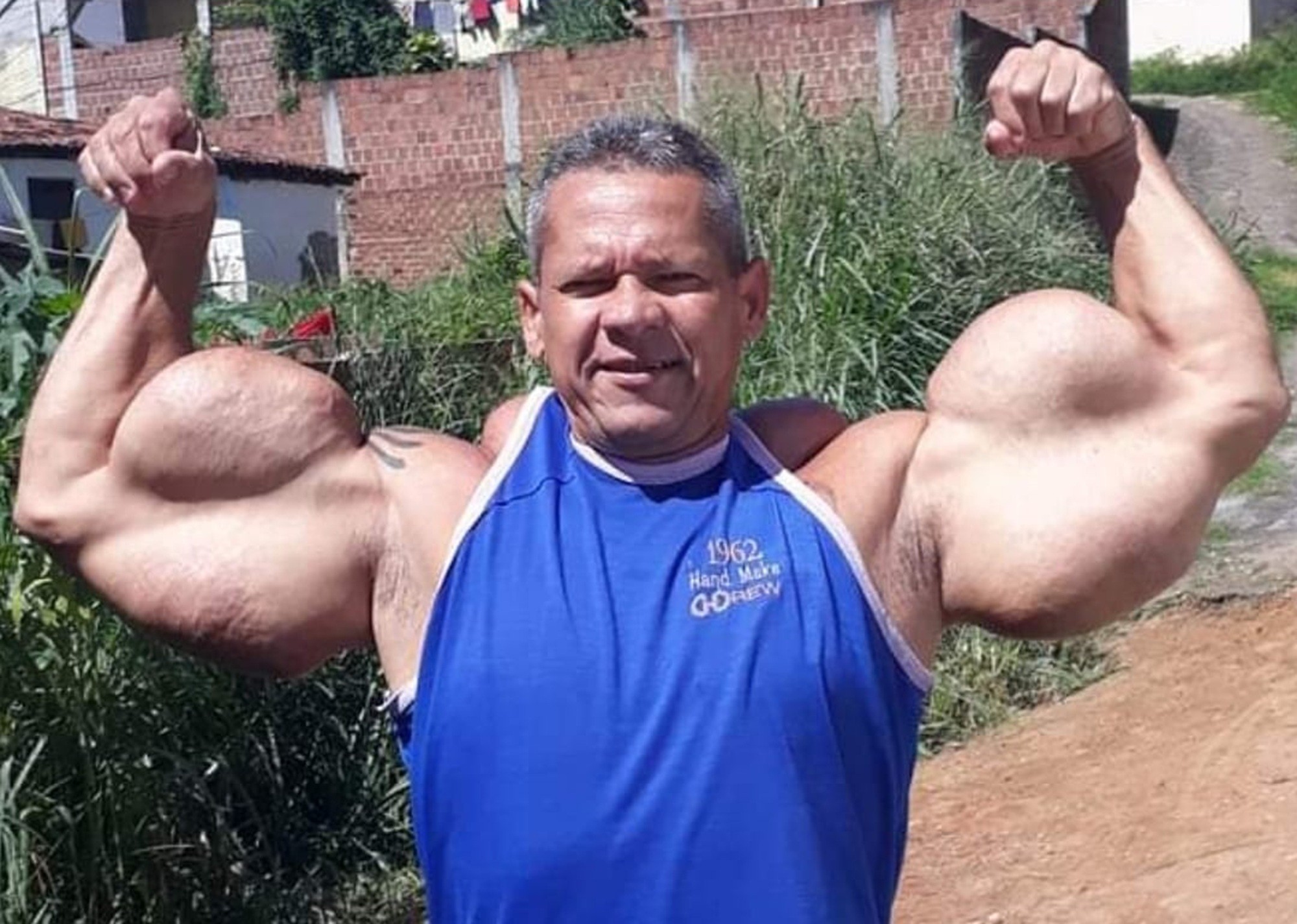 'Popeye Brasileiro': quem era homem famoso por injetar óleo nos braços | G1