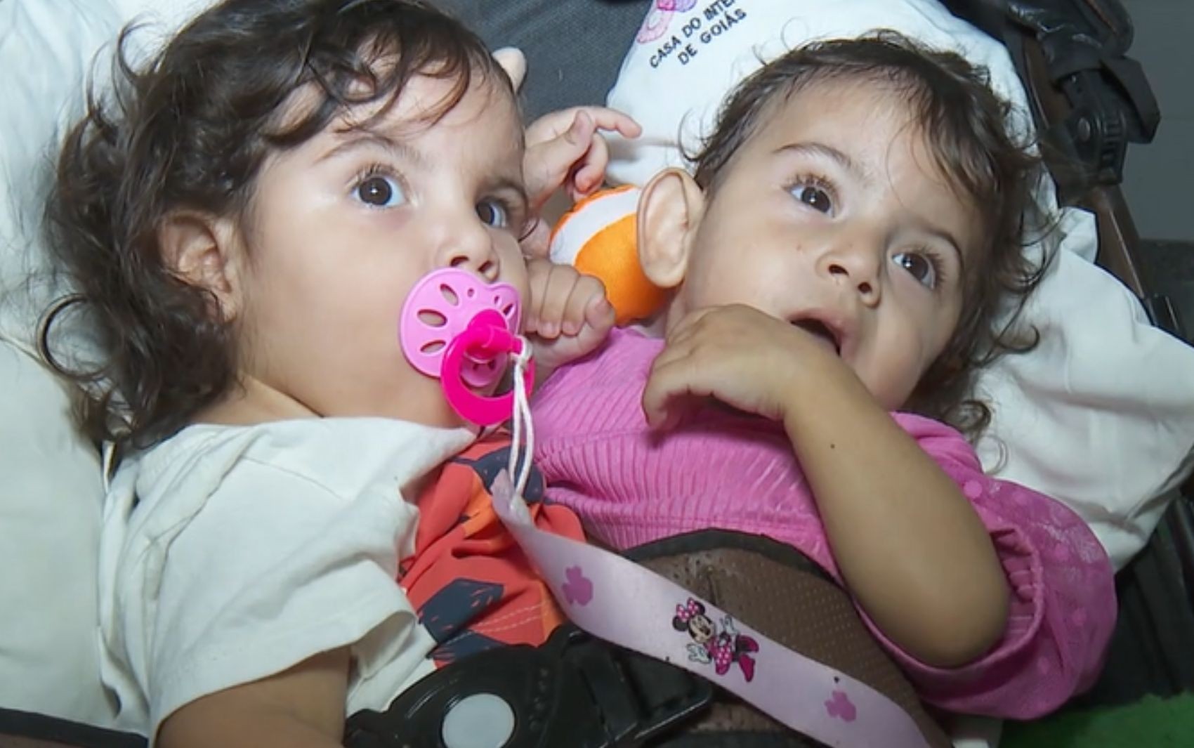 Siamesas de São Paulo unidas pelo tórax, abdômen e bacia passam por ...