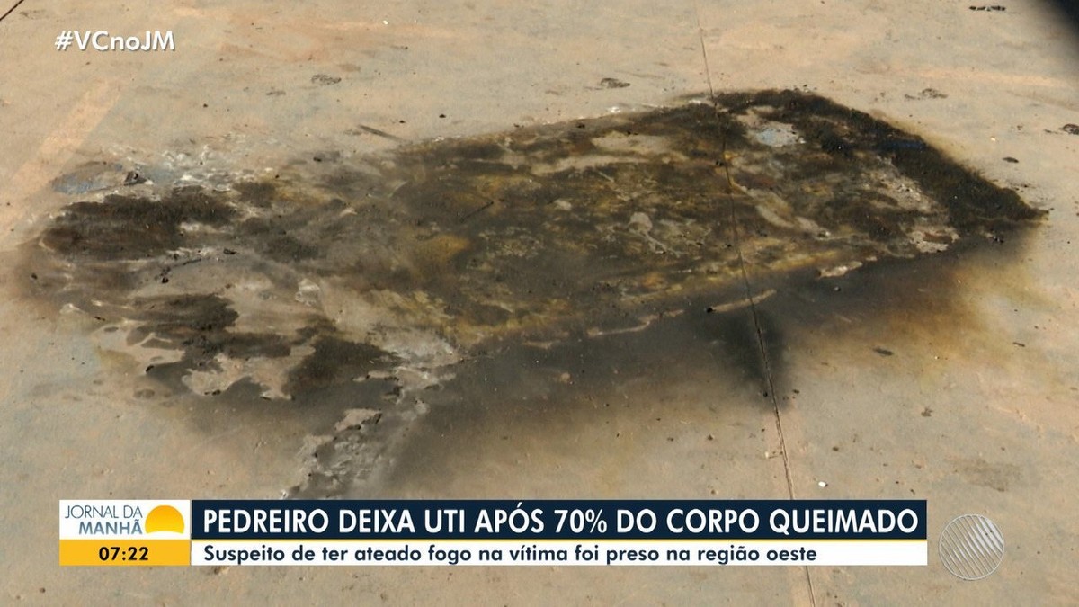 Homem em situação de rua que teve quase 70% do corpo queimado enquanto ...