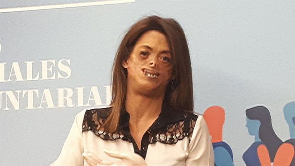 Doença de Günther: como é viver com condição devastadora que ataca ...