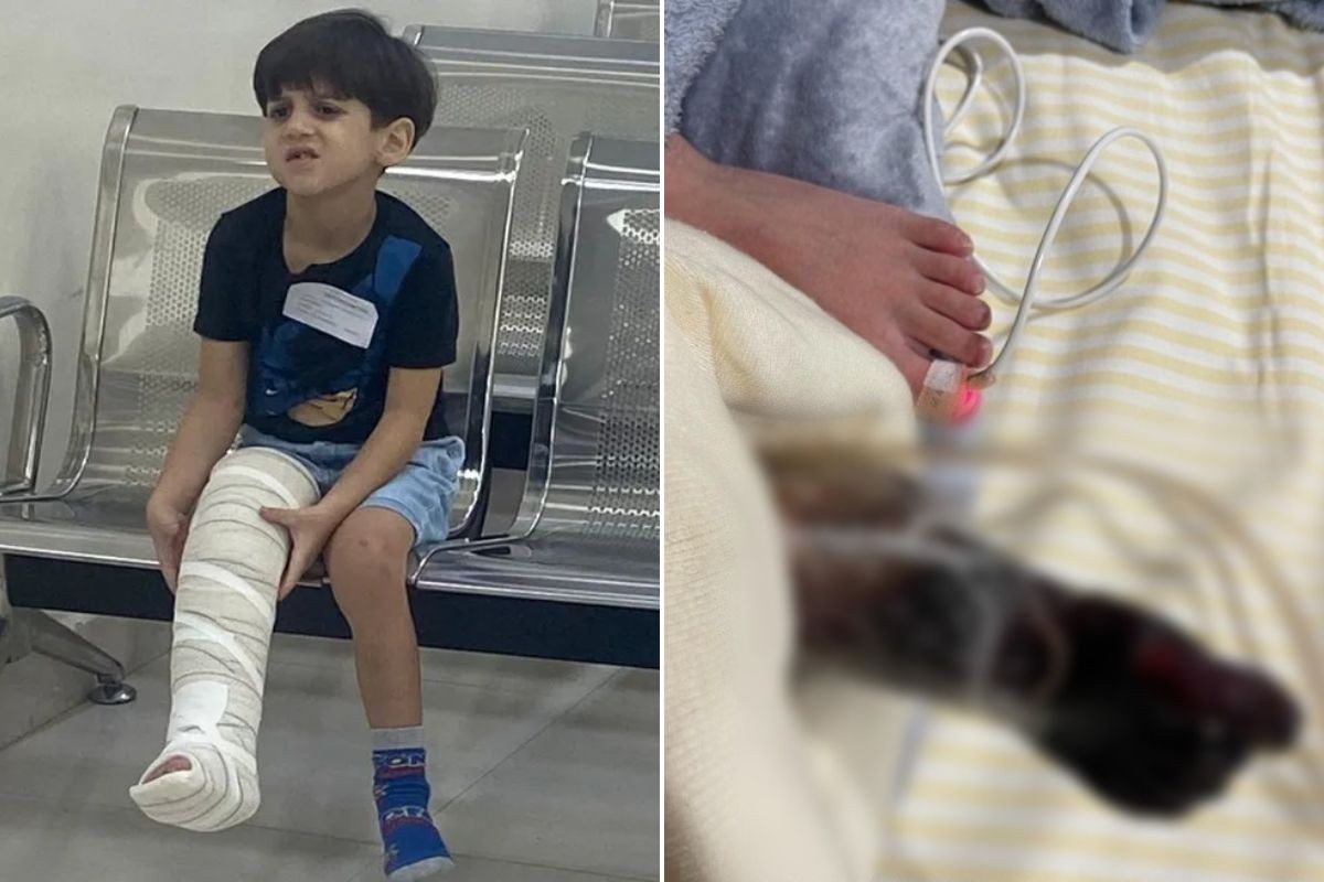 Menino que recuperou perna após pular do sofá passa por cirurgia para ...