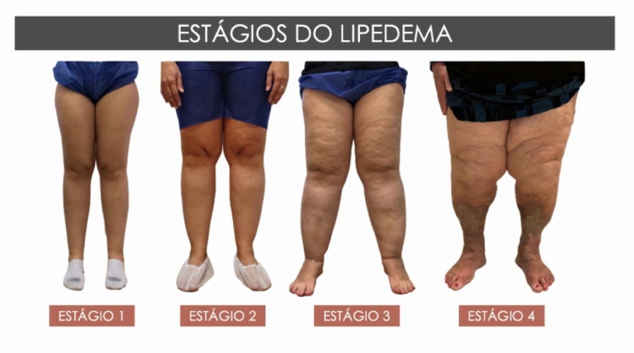 Lipedema: entenda a doença que causa acúmulo de gordura e é confundida ...