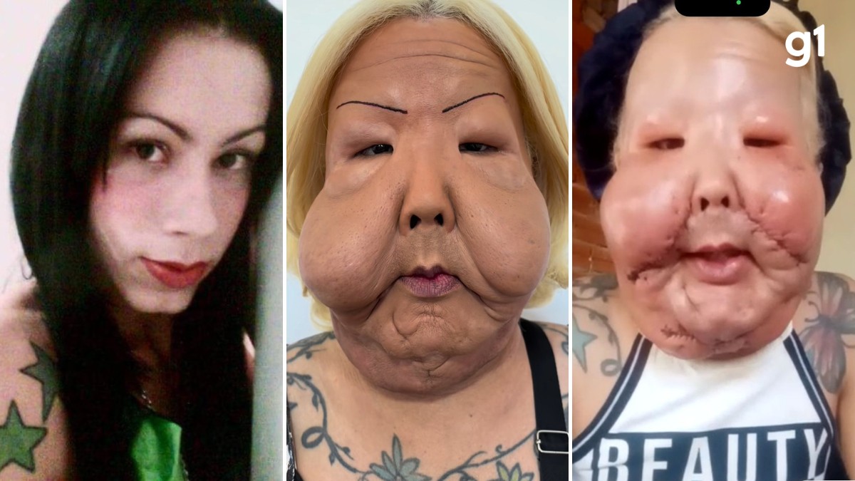 Juju do Pix fala pela 1ª vez após cirurgia para retirar óleo do rosto | G1