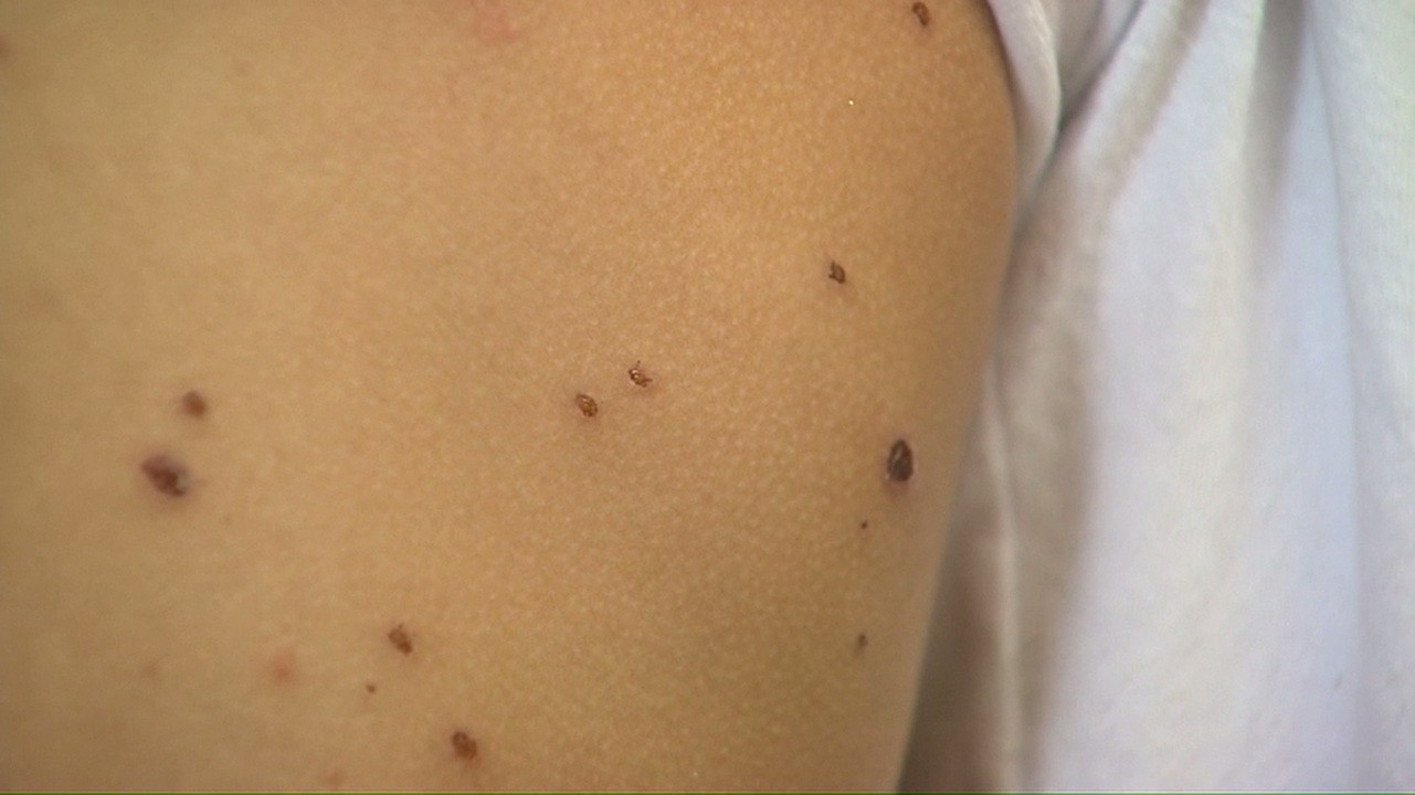 É possível morrer de catapora (varicela)? Entenda a doença que afetou o ...