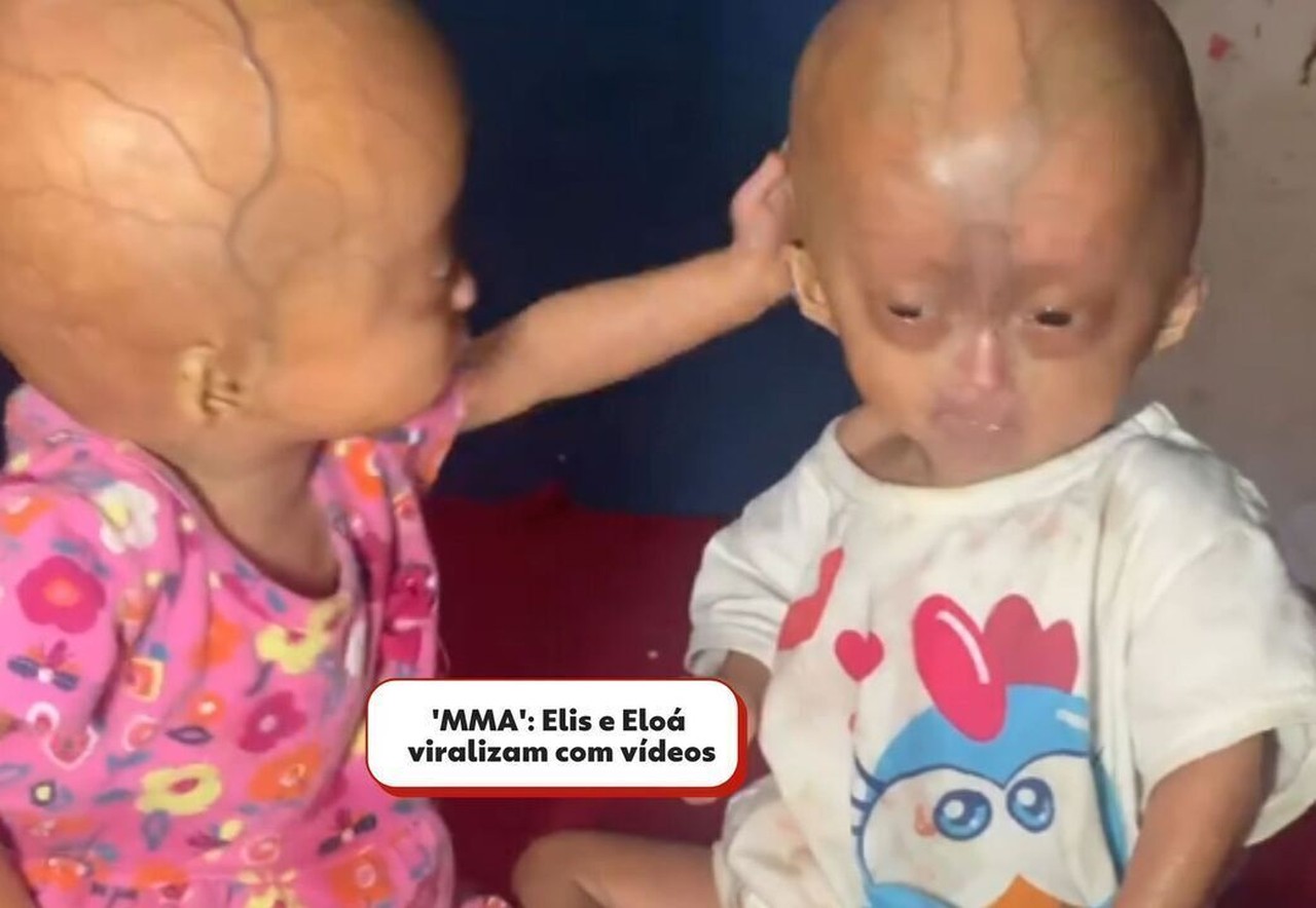 Gêmeas com síndrome do envelhecimento viram fenômeno na internet e conquistam fãs: 'recebem ...