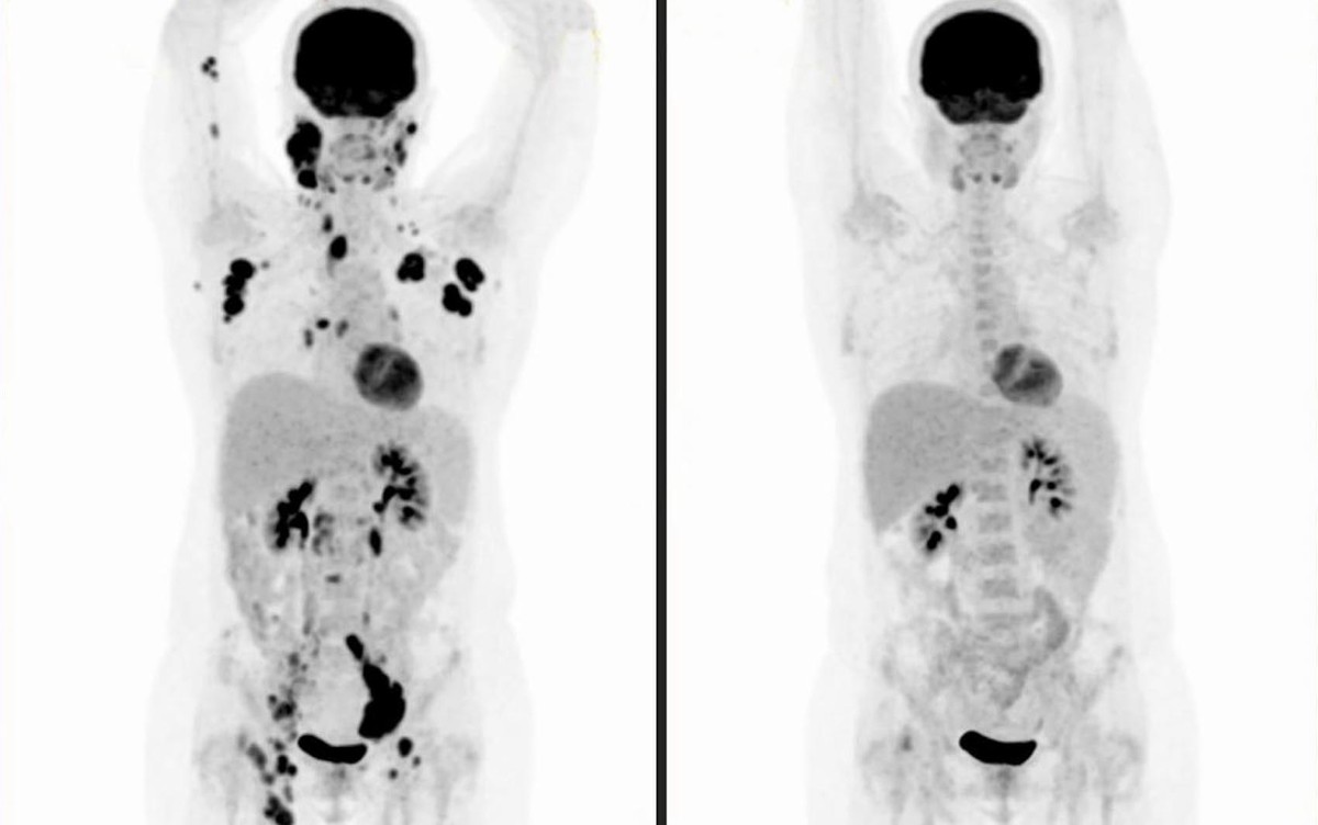 CAR-T Cell: Veja como será seleção de pacientes para estudo clínico de ...