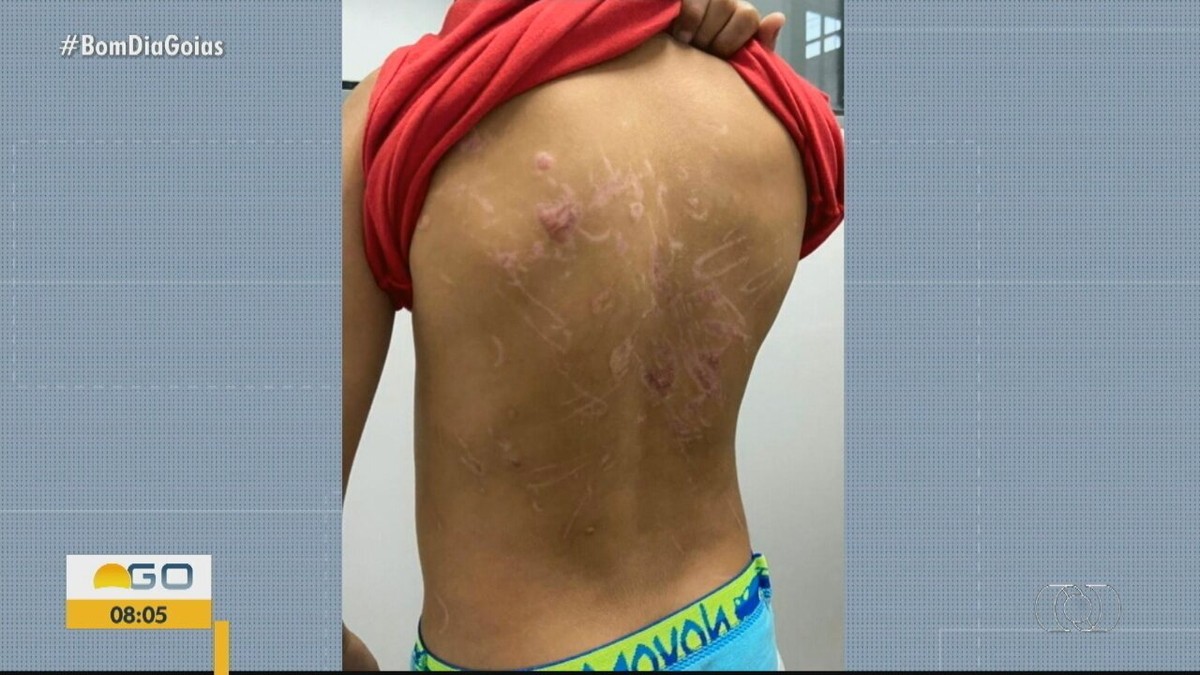 Pai é Preso Suspeito De Torturar O Filho De 8 Anos Com Choques