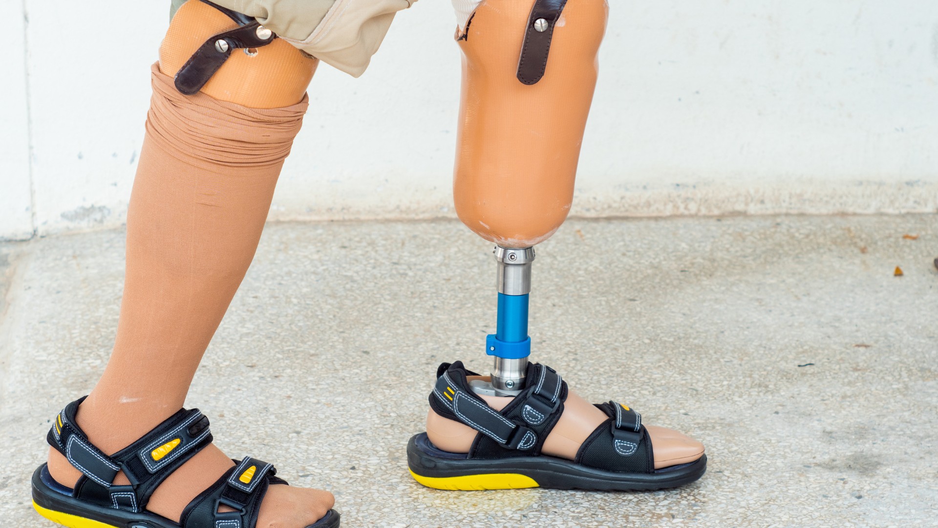 Próteses ortopédicas: Conheça diferentes tipos