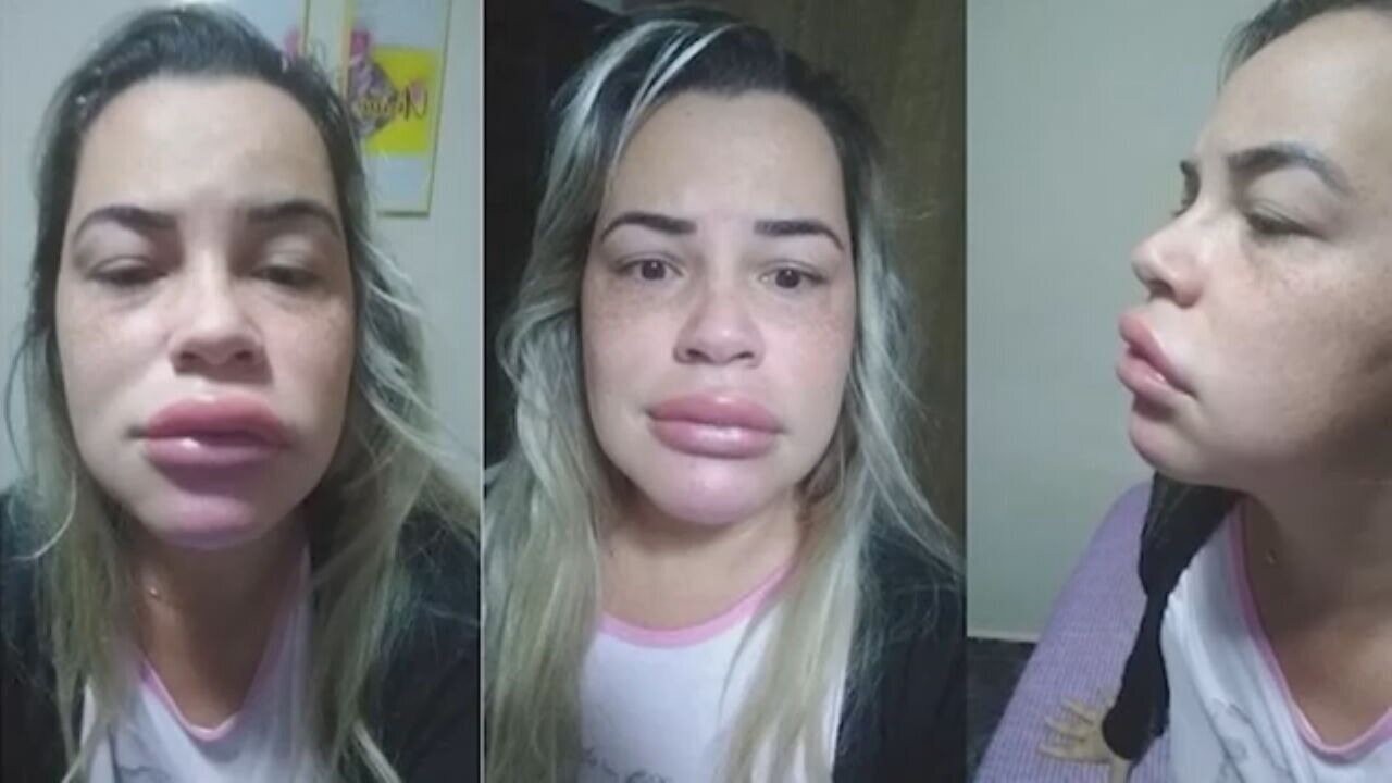PMMA: que substância é essa, como ela é usada na medicina e por que ...