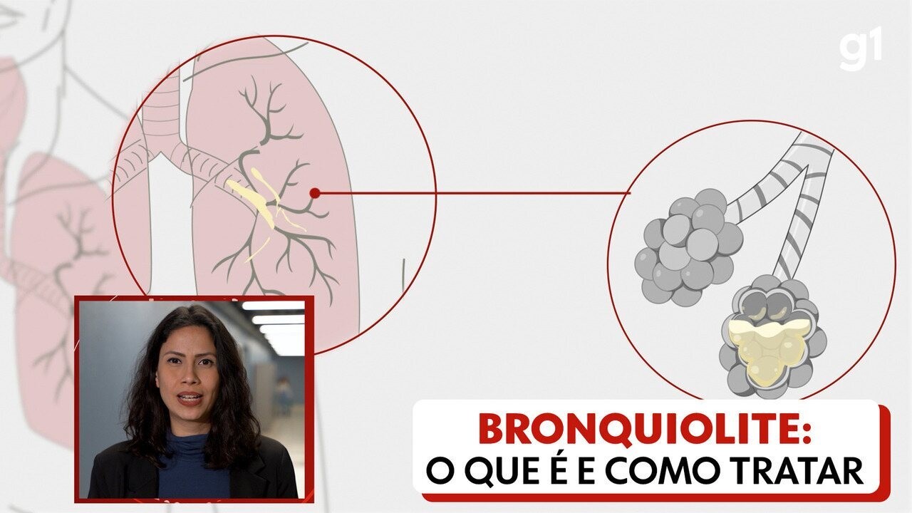 Bronquiolite: da infecção pelo VSR à falta de ar em crianças; veja ...