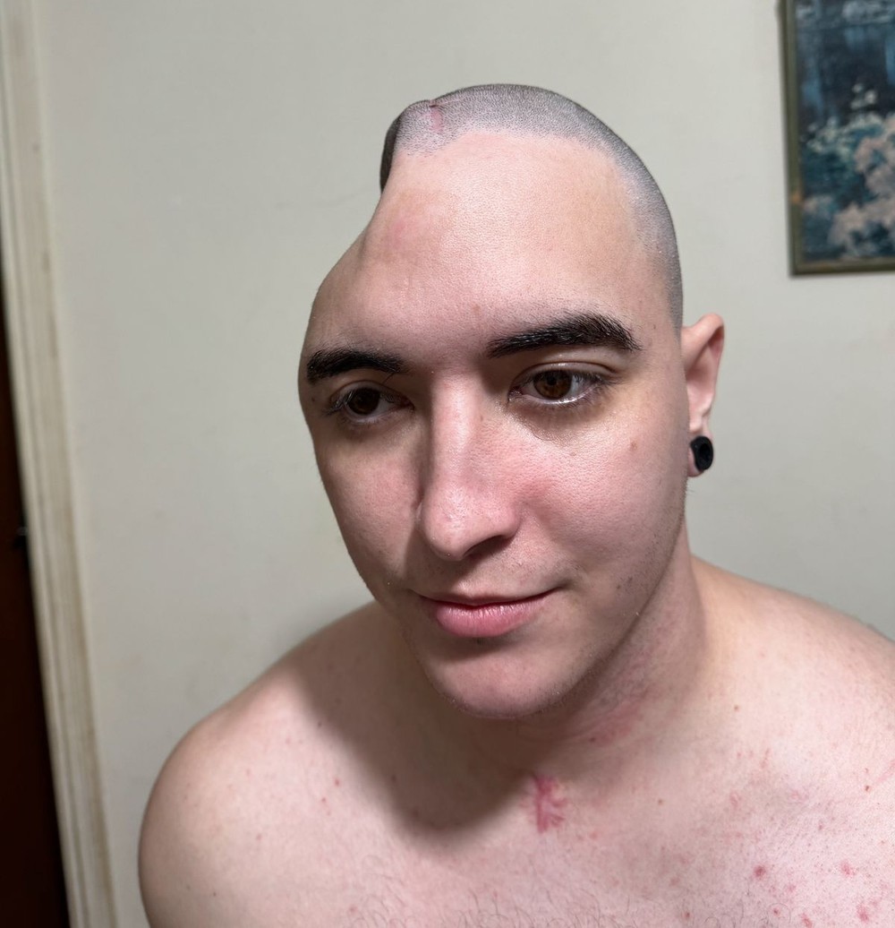 Jovem de Toledo viraliza ao contar que ficou meses com parte do crânio ...