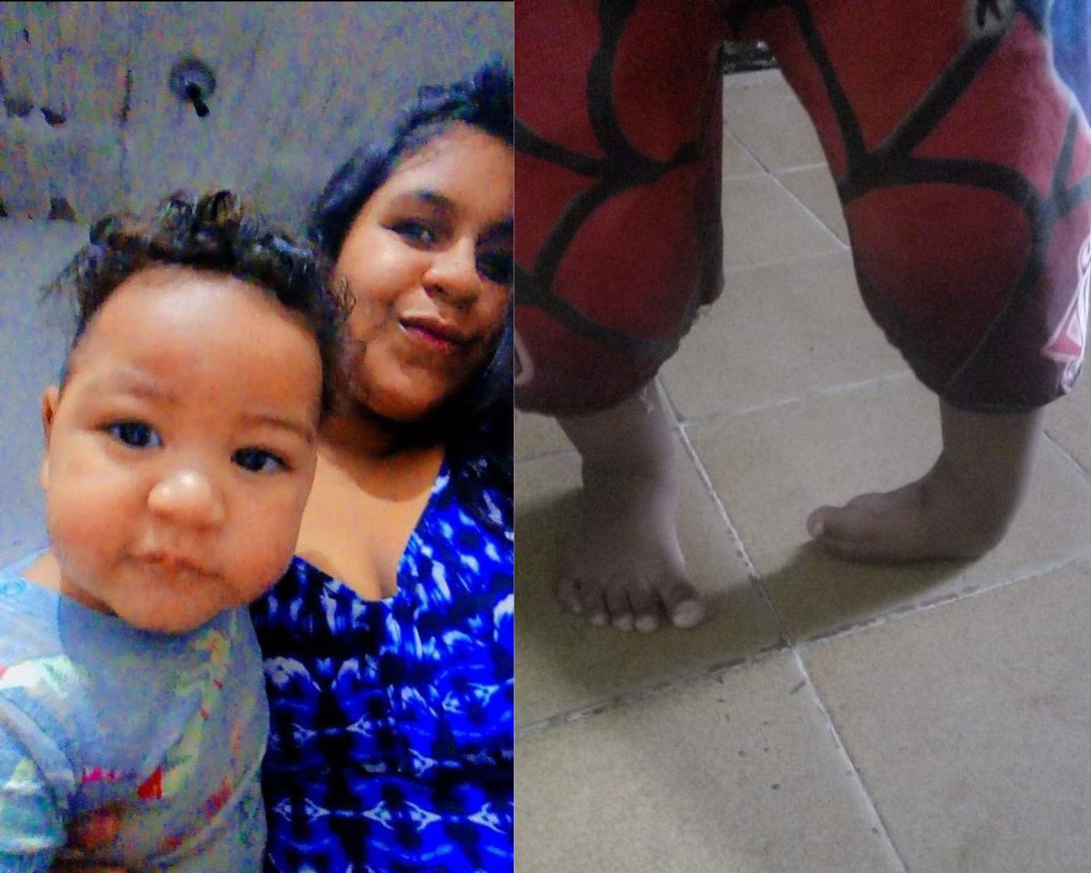Família luta há um ano por cirurgia para bebê que nasceu com 'pé torto ...