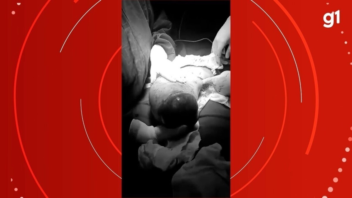 VÍDEO: bebê nasce empelicado e parto é inédito em hospital de MS | Mato ...