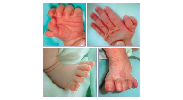 Polidactilia Pos Axial Cirurgia De Polidactilia Infantil