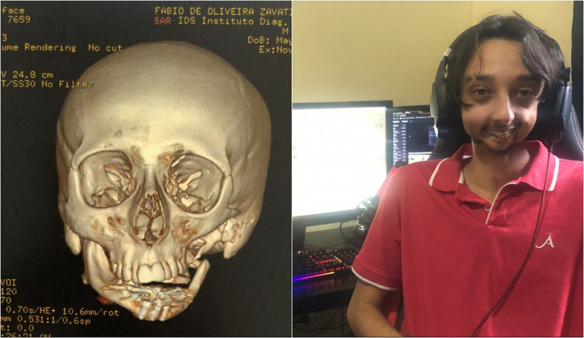 Streamer com maxilar deformado pelo câncer relata cyberbullying em ...
