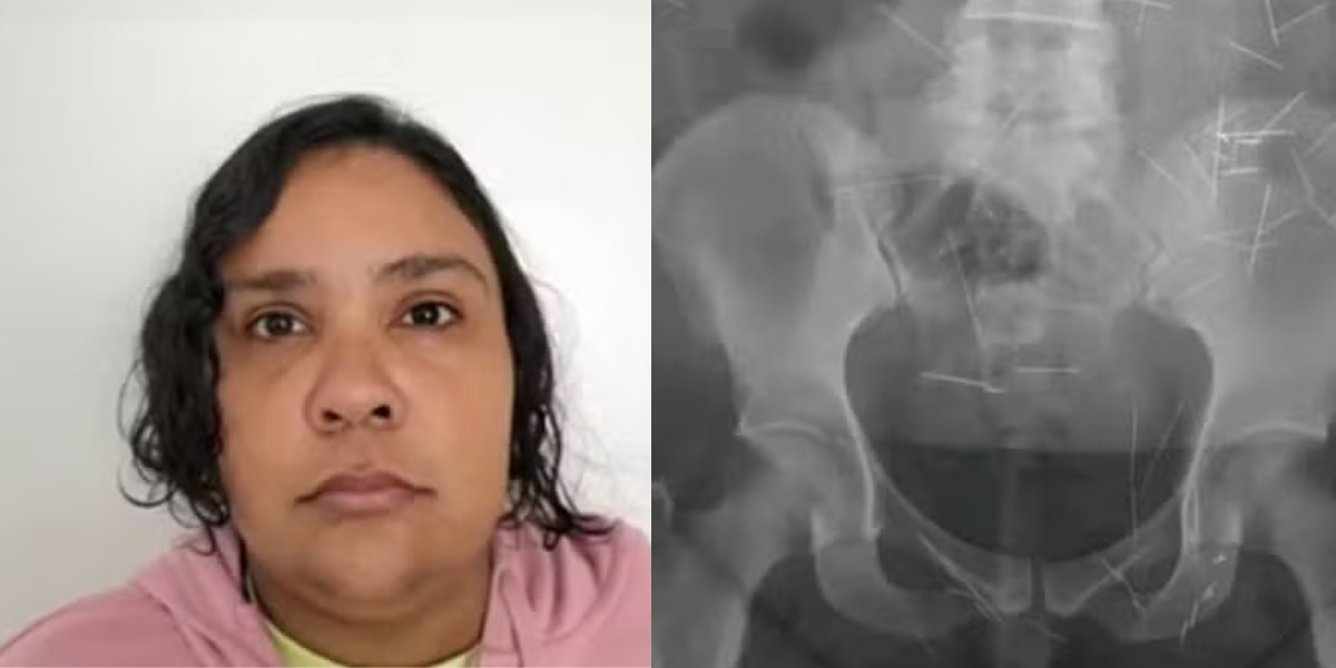 Mulher de 37 anos que fingia ser criança em SC tinha agulhas no corpo | G1