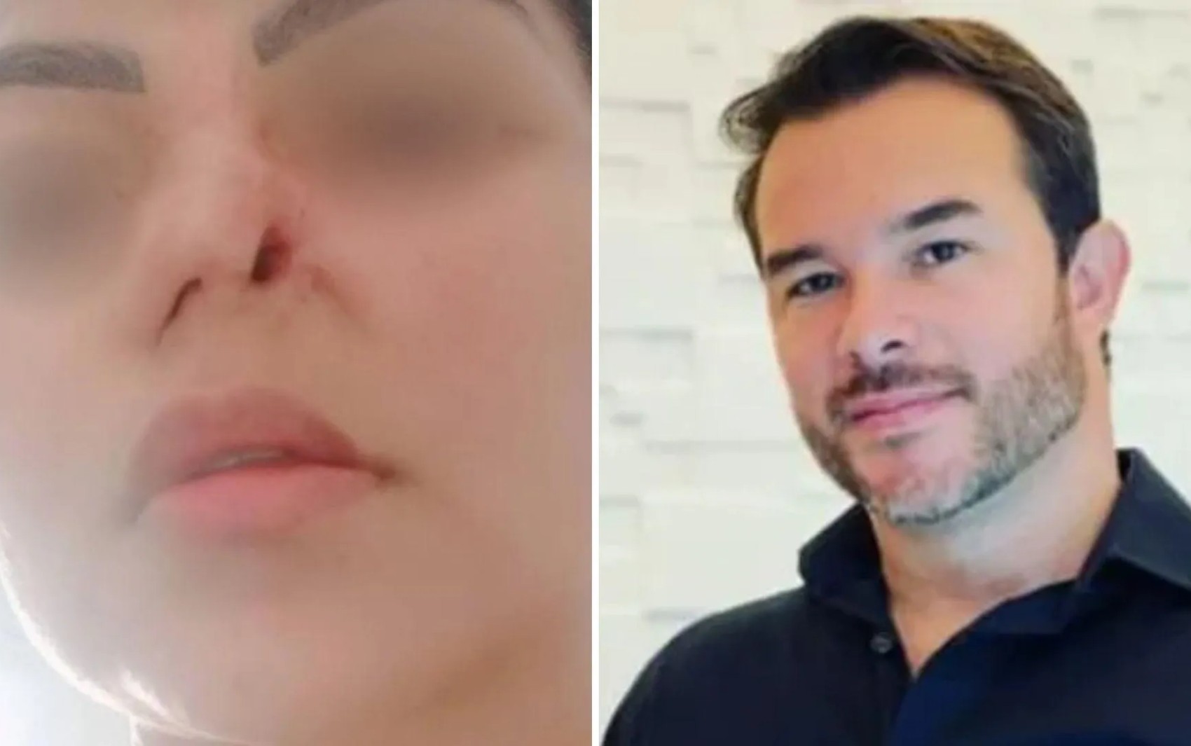 Dentista proibido de atender depois de paciente perder parte do nariz é ...