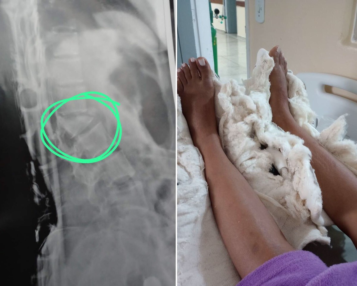 Jovem que caiu de paraglider atingido por linha com cerol fraturou a ...