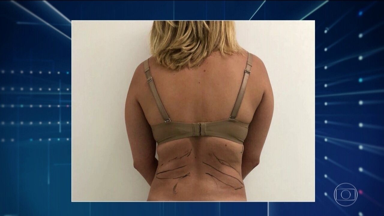 Influenciadora morre no DF após procedimento estético para aumentar glúteos