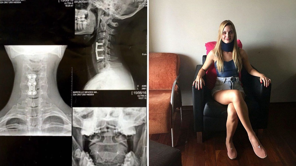 Advogada que perdeu movimentos do corpo ao fraturar coluna vai disputar ...