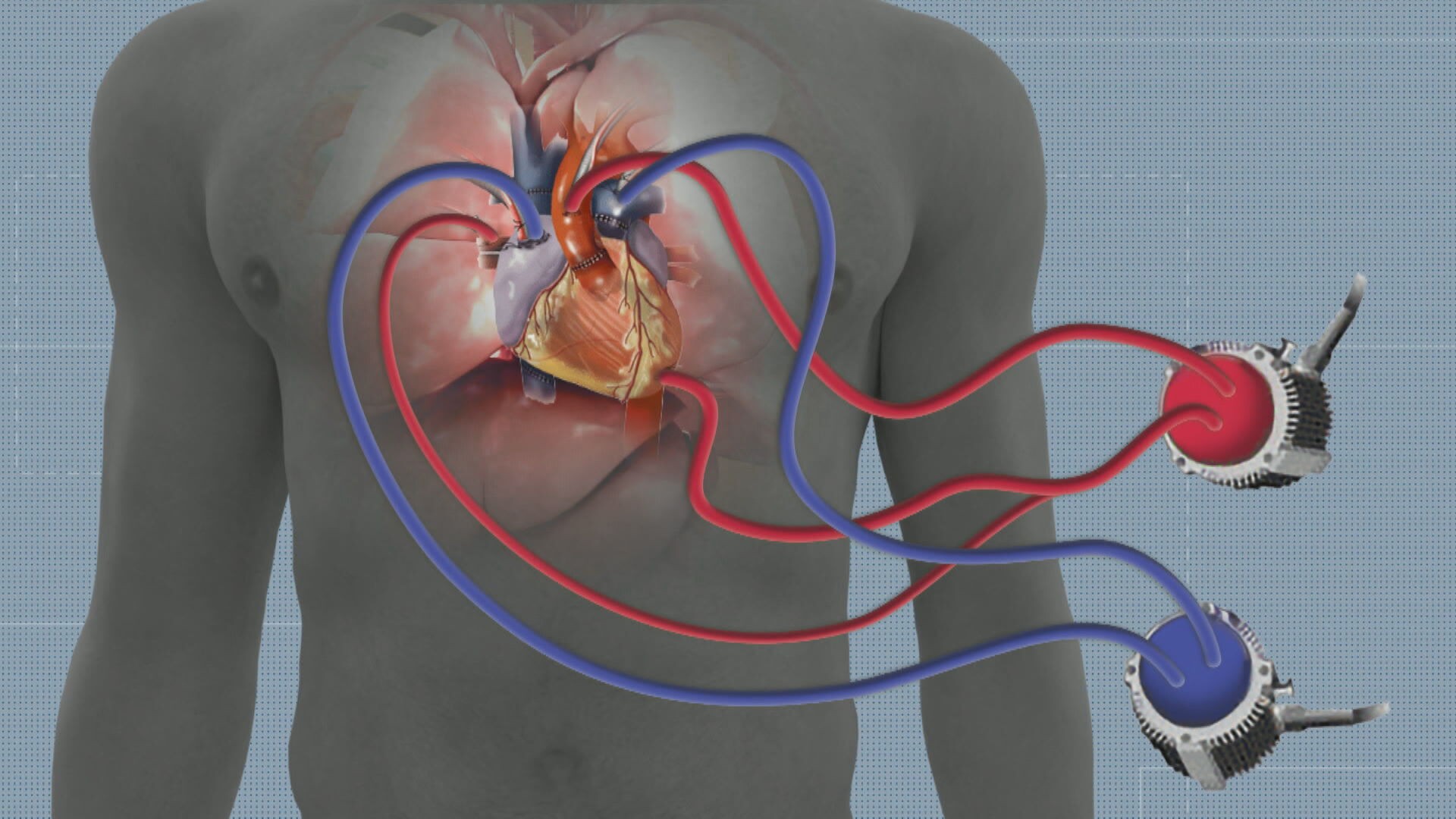 Coração artificial: entenda em 4 pontos como a técnica funciona