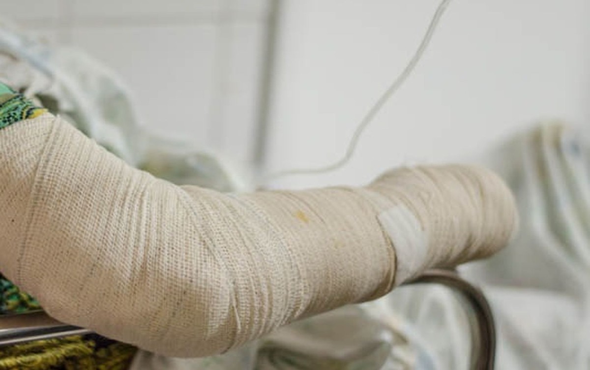 Huse recebe 15 pacientes queimados durante a véspera de São João ...